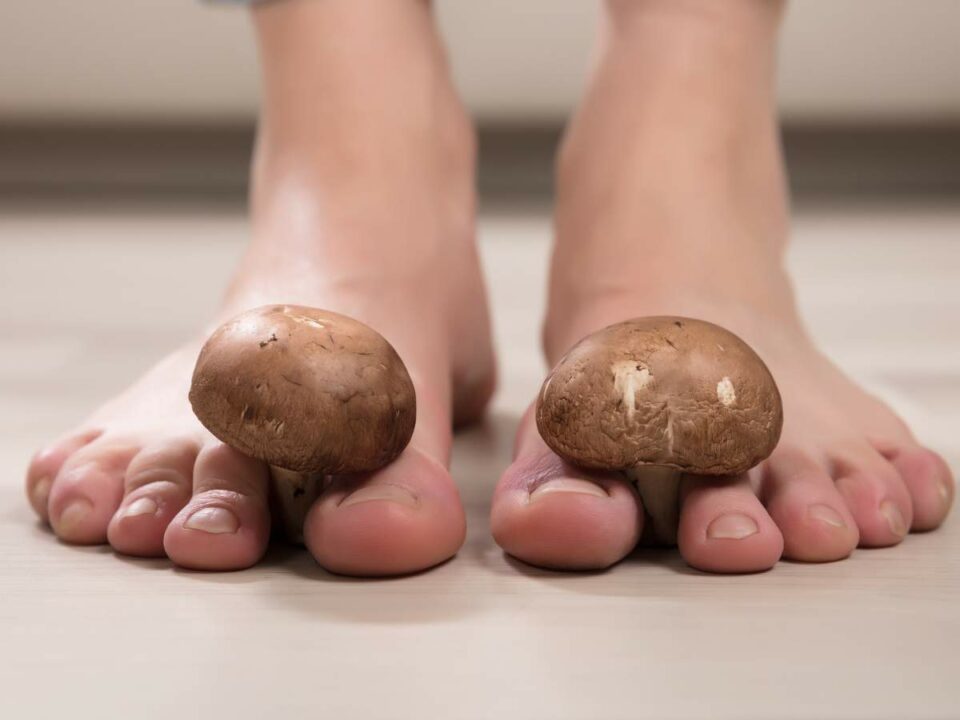 Nail Fungus Essential Oil Blend Recipe To Treat Your Toenail